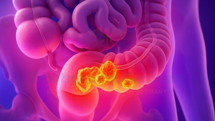 Bowel Cancer Treatment in Germany: Symptoms and Diagnosis